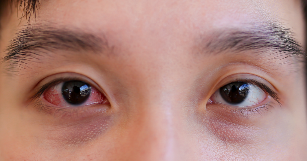 Pink Eye Vs Allergies How To Tell The Difference
