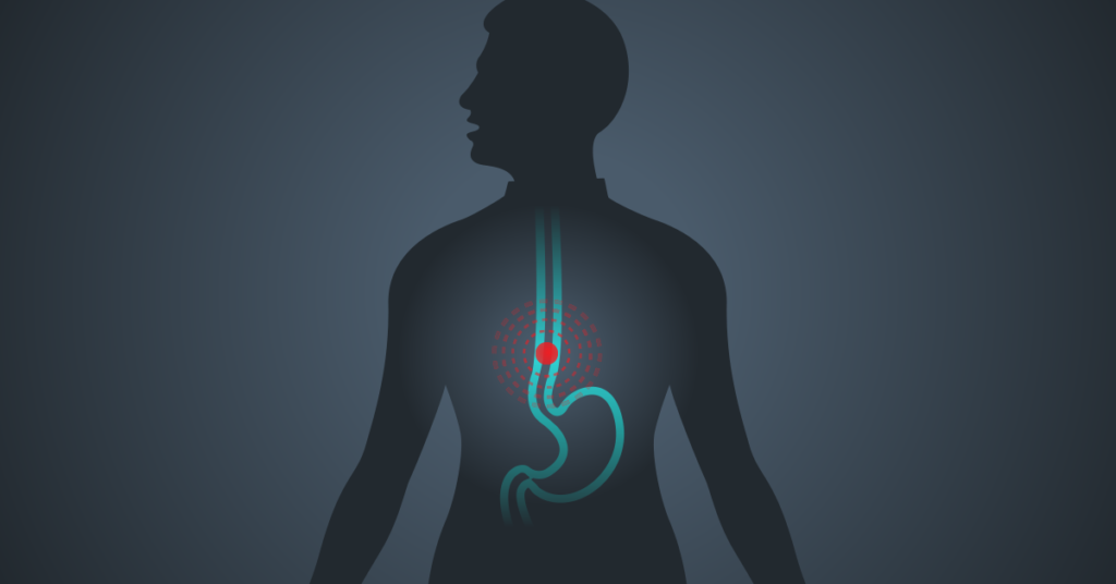 Lower Esophageal Sphincter and Its Anatomy: A Guideline
